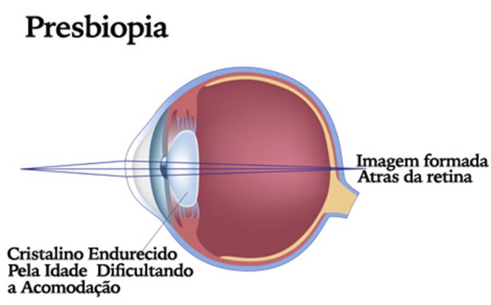 O que é a Visão Embaçada?
