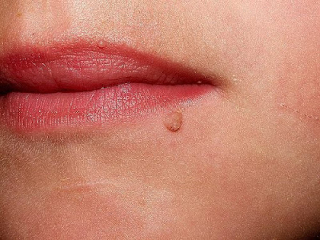 verruga-imagem | Saúde – Blog OPAS