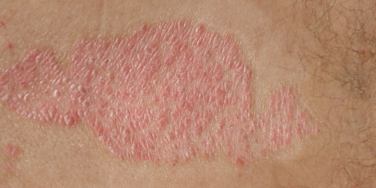 O Que é Psoríase e Como é o Tratamento?