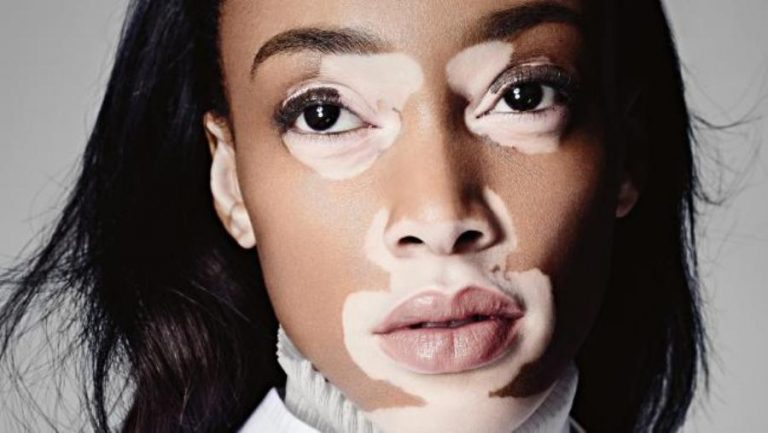 Vitiligo: Cura, o que é, Tratamento, Sintomas, Causas e Mais