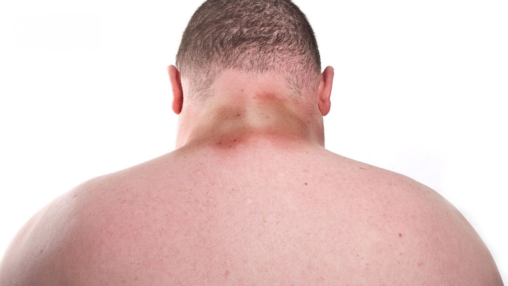 sintomas da Acantose Nigricans | Saúde – Blog OPAS