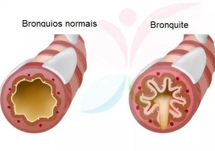 bronquios-bronquite | Saúde – Blog OPAS