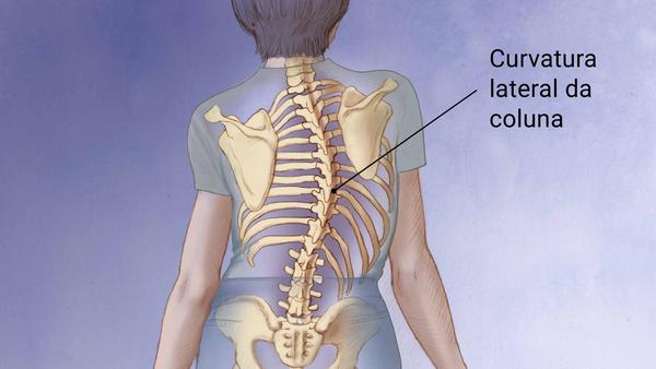 Tudo Sobre Escoliose: Lombar, Cura, Cirurgia, Tratamento e Exercícios