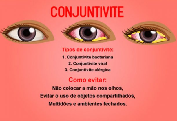 Conjuntivite Viral, Alérgica e Bacteriana: Sintomas e Colírios