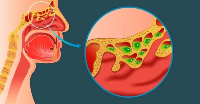 O que é Rinite, Sintomas, Remédios, Tratamento e Mais