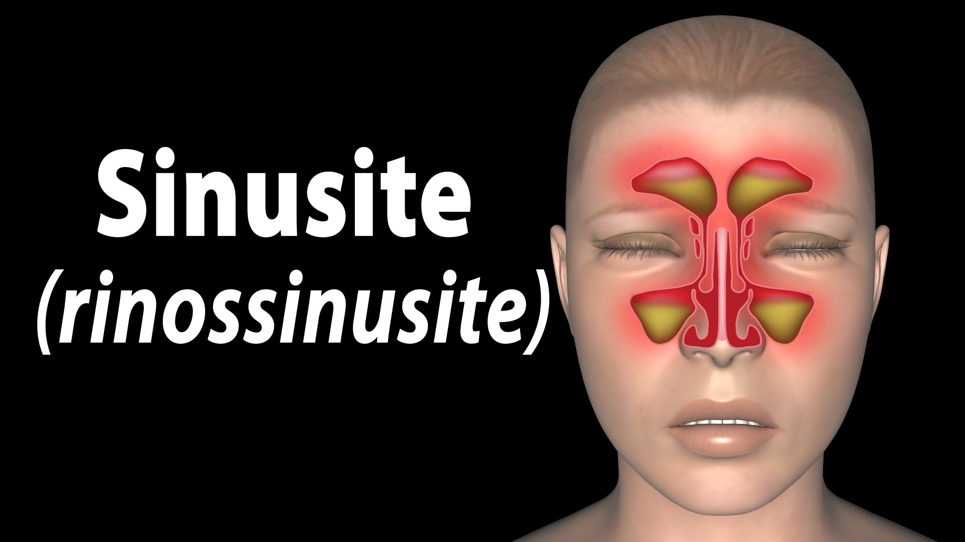 Sinusite | Saúde – Blog OPAS