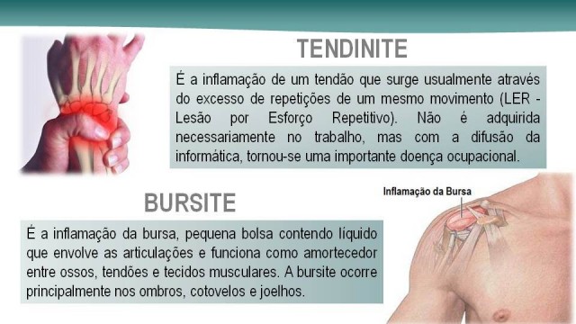 Como Tratar a Tendinite