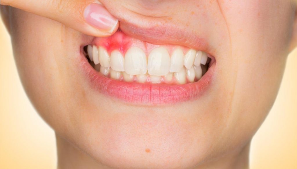 Abcesso Dentário: O que é? Como é seu Tratamento?