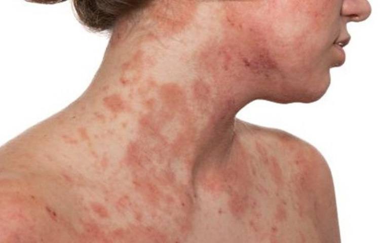 Dermatite Numular | Saúde – Blog OPAS